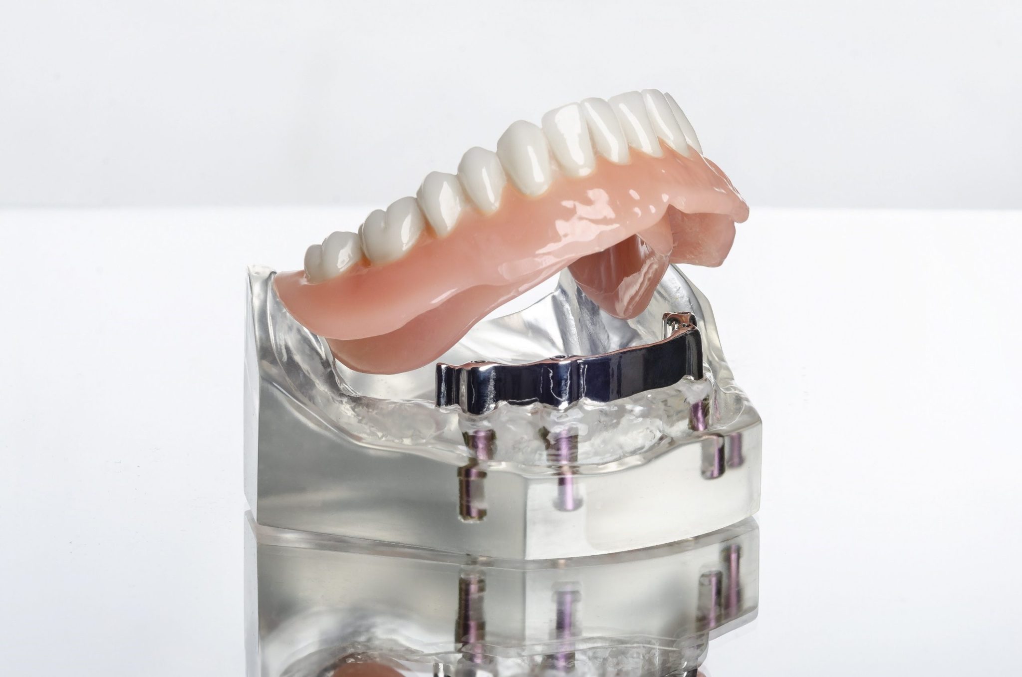 Guide for Transitioning from Dentures to Dental Implants - Dentist in ...